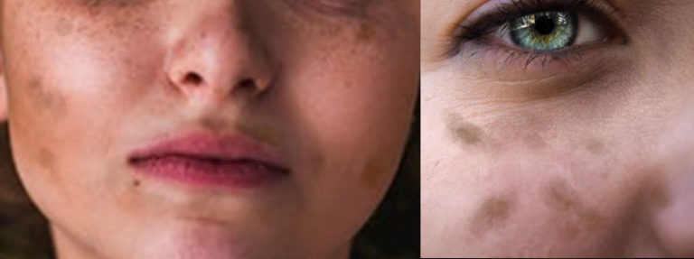 Women With Facial Light Or Dark Spots Discoloration Or Uneven Skin Tone Wanted For Paid Market women-with-facial-light-or-dark-spots-discoloration-or-uneven-skin-tone-wanted-for-paid-market